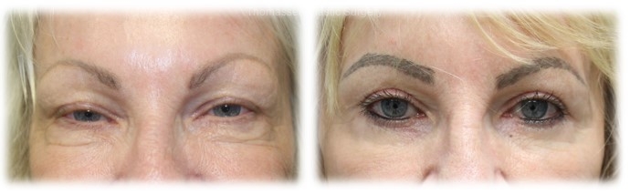 Thomassen Plastic Surgery - Blepharoplasty (Eyelid Lift) Before and Afters